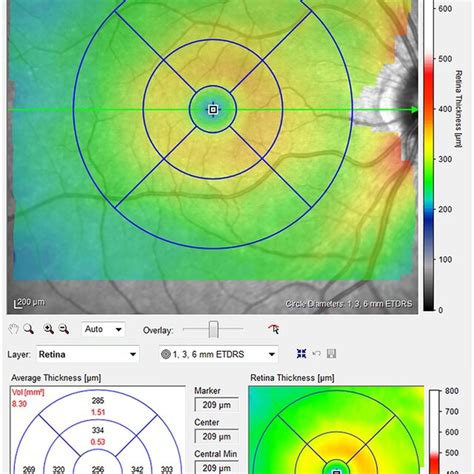 retinal thickness analysis algorithm in which mean thicknesses in