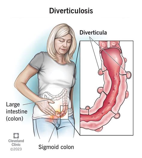 Symptoms Of Diverticulosis Medizzy