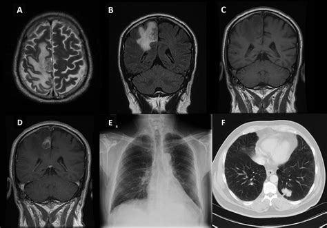 X Ray Brain Tumor