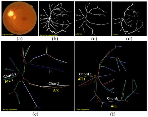 A Comparison Of The Tortuosity Phenomenon In Retinal Arteries And Veins