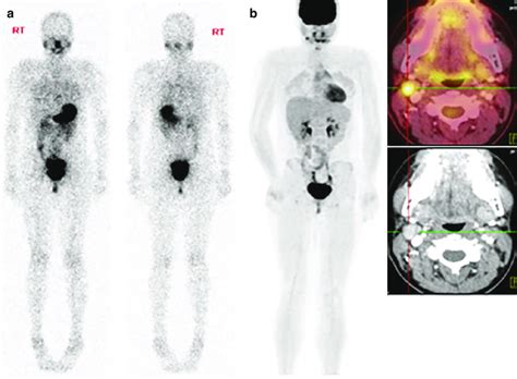 9 History A 14 Year Old Girl Presented With A Right Thyroid Nodule Download Scientific