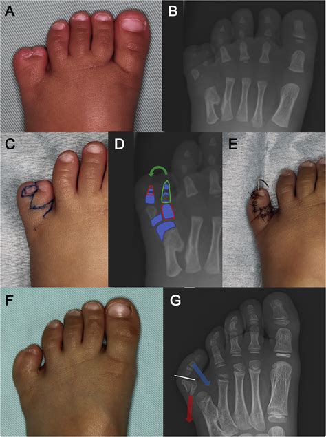 Treatment For Lateral Ray Polydactyly With Brachydactyly Of The Foot The Journal Of Foot And