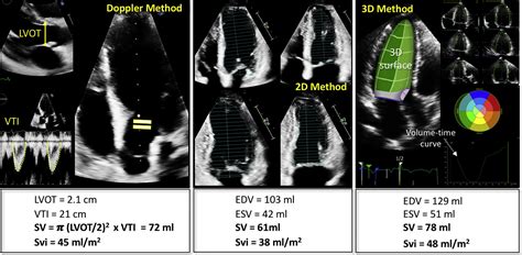 Normal Values Of Cardiac Output And Stroke Volume According To Measurement Technique Age Sex