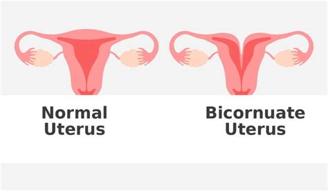 Bicornuate Uterus Symptoms Causes And Treatment Tua Saúde