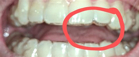 Aligner 7 14 Started Not Fitting Invisalign