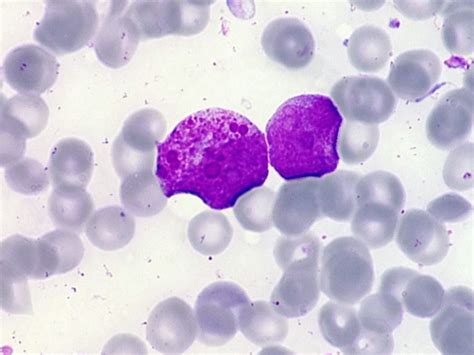 Acute Promyelocytic Leukaemia Typical Hypergranular Variant