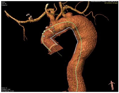 Young Patient With Previous Ascending Aorta Replacement After Acute