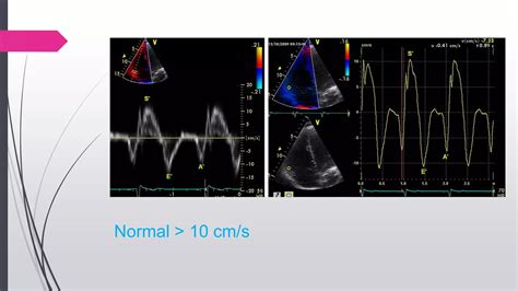 Echo Assessment Of Rv Function Pptx