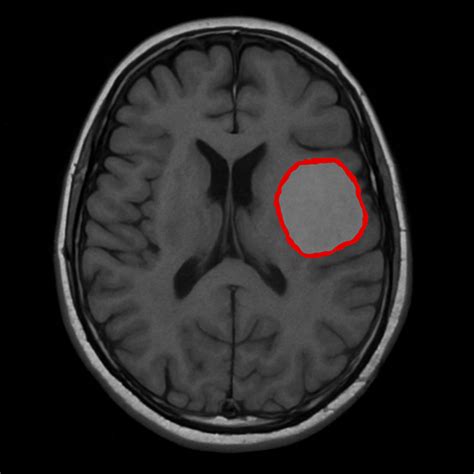 Brain Tumor Dataset Segmentation And Classification Kaggle