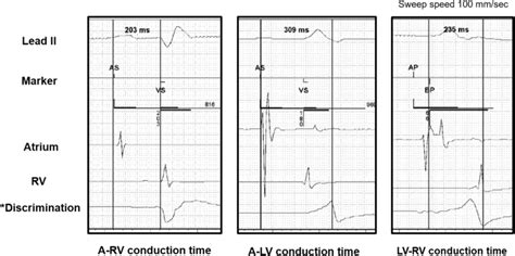 Measurement Of Interelectrode Conduction Times Using Intracardiac Download Scientific Diagram