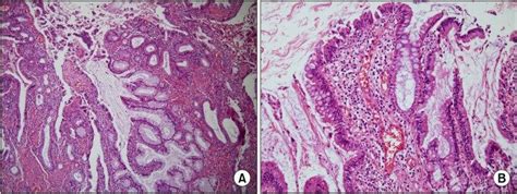 A Pyloric Gland Metaplasia In The Gallbladder H E B Download Scientific Diagram