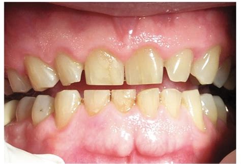Chapter 20 Abnormalities Of The Teeth Flashcards Quizlet