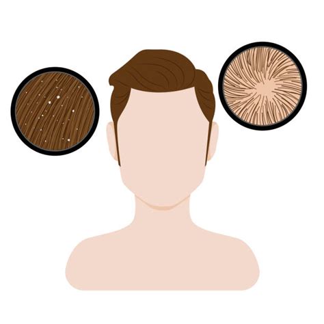 Dry Scalp Illustrations Royalty Free Vector Graphics And Clip Art Istock