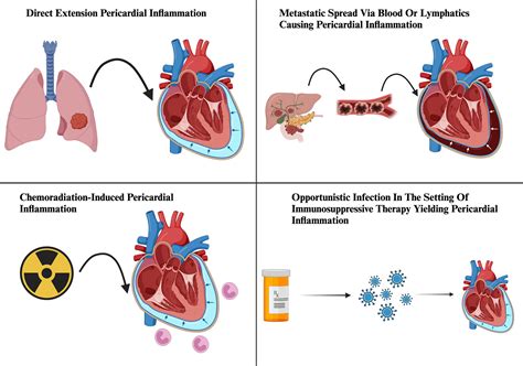 The Heart 🔴“malignant Pericardial Effusion A Review” Facebook