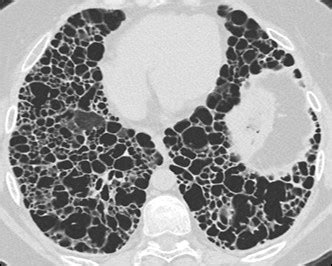 Idiopathic Pulmonary Fibrosis Ncbi