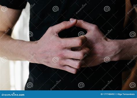 Cracked Flaky Skin On The Hands Dermatological Problems Of Psoriasis