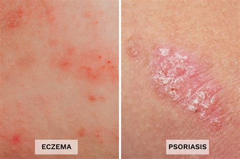 Eczema vs. Psoriasis: 13 Differences You Should Know | The Healthy