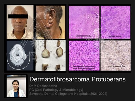 Dermatofibrosarcoma Protuberans — Oral Pathology Saveetha