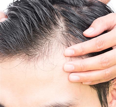 Scalp Health Dr Sunny Medical Center Sharjah
