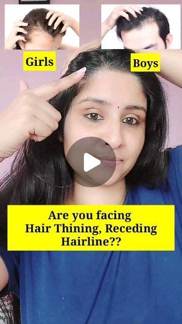 Shalini ♥️ On Instagram 🌟🌟bald Patches Thining Hairline Big