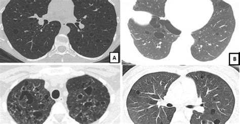 Pulmonary Insights Diffuse Cystic Lung Diseases Definitive Diagnosis Is Essential For