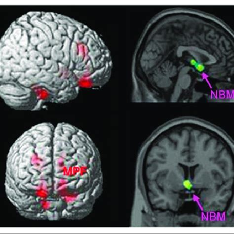 Statistical Parametric Mapping Based Correlations Between 11 C Meqaa A7 Download Scientific