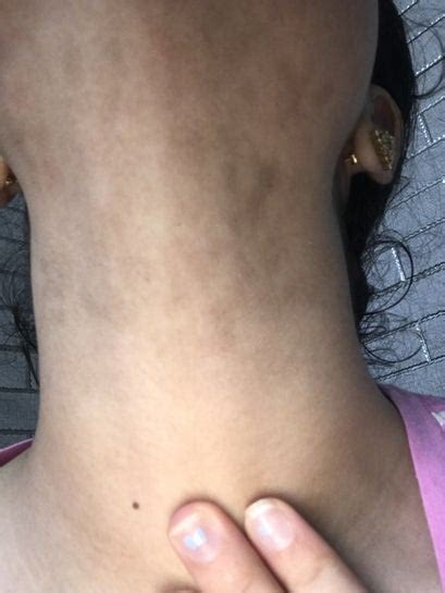 What Causes Black Spots On The Face And Neck
