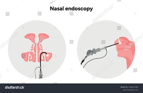 Nasal Endoscopy Procedure Nasal Sinus Passages Stock Vector Royalty