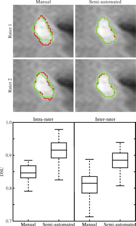 Variability Of Semi Automated Vs Manual Segmentation Tools Lesion