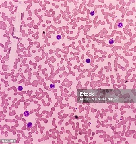Photomicrograph Of Hematological Slide Showing Rbc Wbc And Platelet