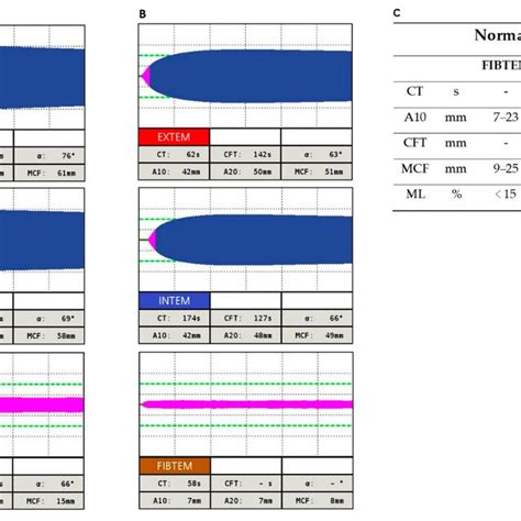 Rotational Thromboelastometry Extem Extrinsically Activated Download Scientific Diagram
