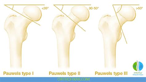 Femoral Neck Fractures Classification Treatment And Prognosis Guide
