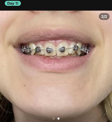 1 Yearish Update Kinda Need Help Rbraces