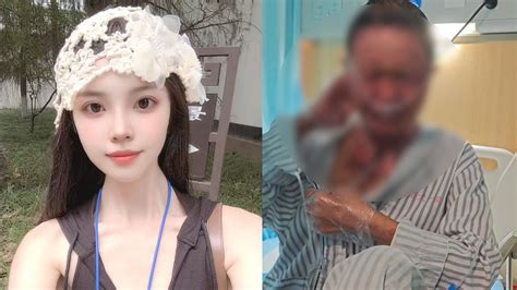 30岁高颜值女子头孢过敏导致毁容：没有头孢过敏史，护士说我很痛是正常的 腾讯新闻