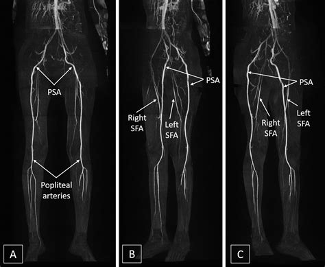 Bilateral Persistent Sciatic Arteries A Rare Anatomical Variant Bmj