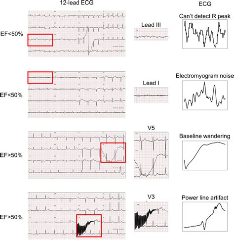 Signals With Excessive Ecg Noise Such As R Peak Detect Error