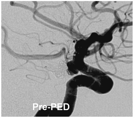 Pipeline Device Aneurysm Selection
