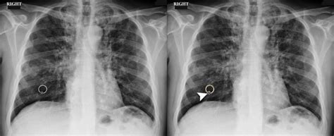 Chest X Ray Devices And Artifacts Pcp And Nipple Ring