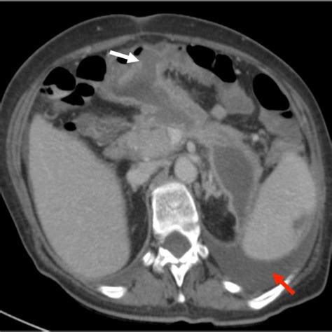 Ct Severity Index And Modified Ct Severity Index 1617 Download Table