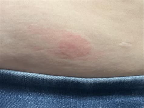 Rash At Injection Site On 10mg R Mounjaro
