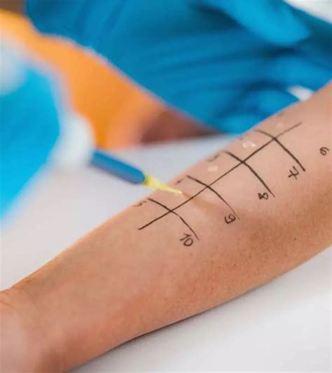 Skin Allergy Test 4 Essential Types Explained