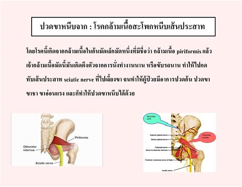 Piriformis Syndrome‼️ ปวดขาหนีบ ปวดก้น ปวดขา ขาชา ขาอ่อนแรงหายได้💯 📍กายภาพบำบัดทำอะไรได้มากกว่า