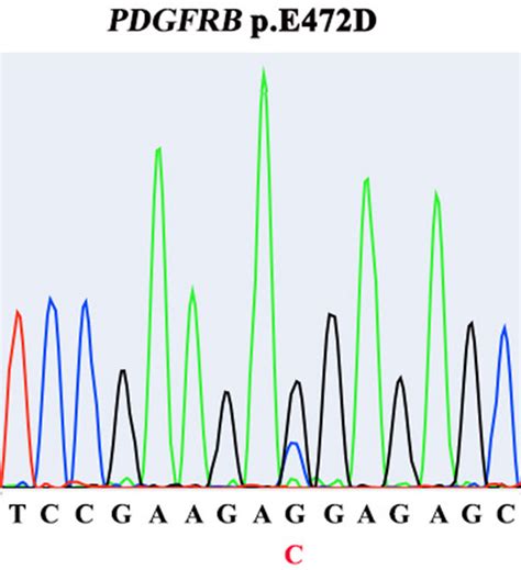 Presence Of Pdgfrb E472d Mutation In Tumor Tissue Identified By Sanger Download Scientific