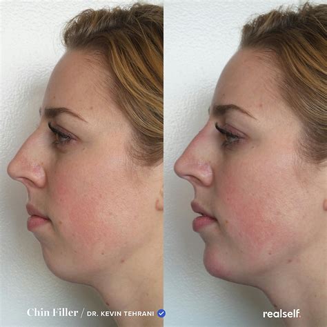 Which Fillers Work Best Where Dermatologists Break It Down