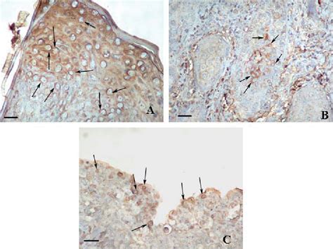 Figure 3 From Immunohistochemical Detection Of Matrix Metalloproteinases Mmp And Epidermal