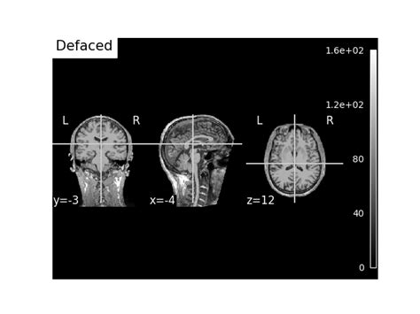 Save And Load T1 Weighted Mri Scan Along With Anatomical Landmarks In