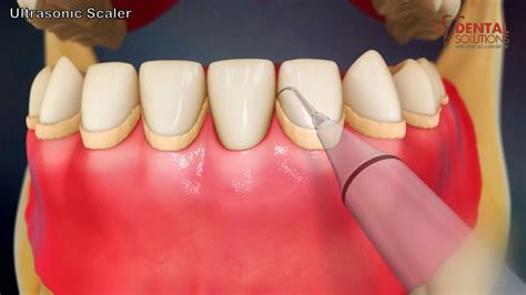Dental Scaler Working Principle At Missy Lynch Blog
