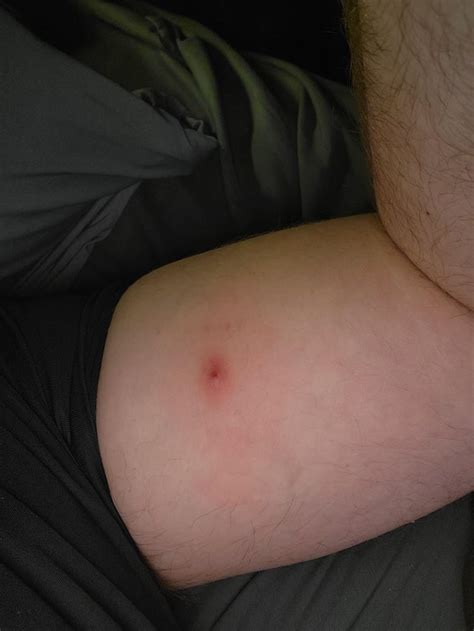 Bump Wound Rmedicaladvice