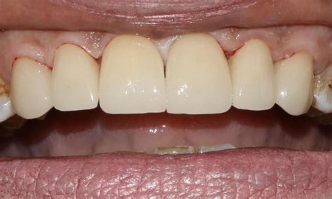 6 Unit Bridge Before And After Smile Gallery Photos Mona Vale Nsw