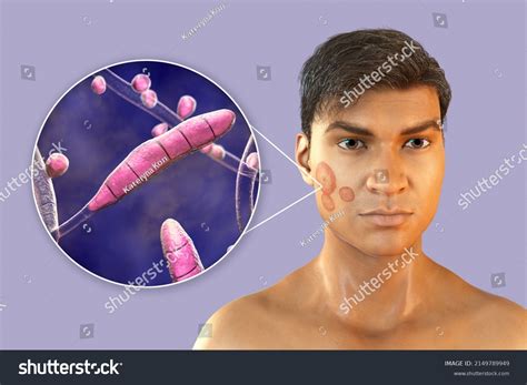 Fungal Infection On Mans Face 3d Stock Illustration 2149789949